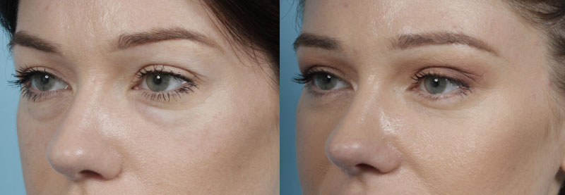 Lower Eyelid Gallery - Dr. Alghoul