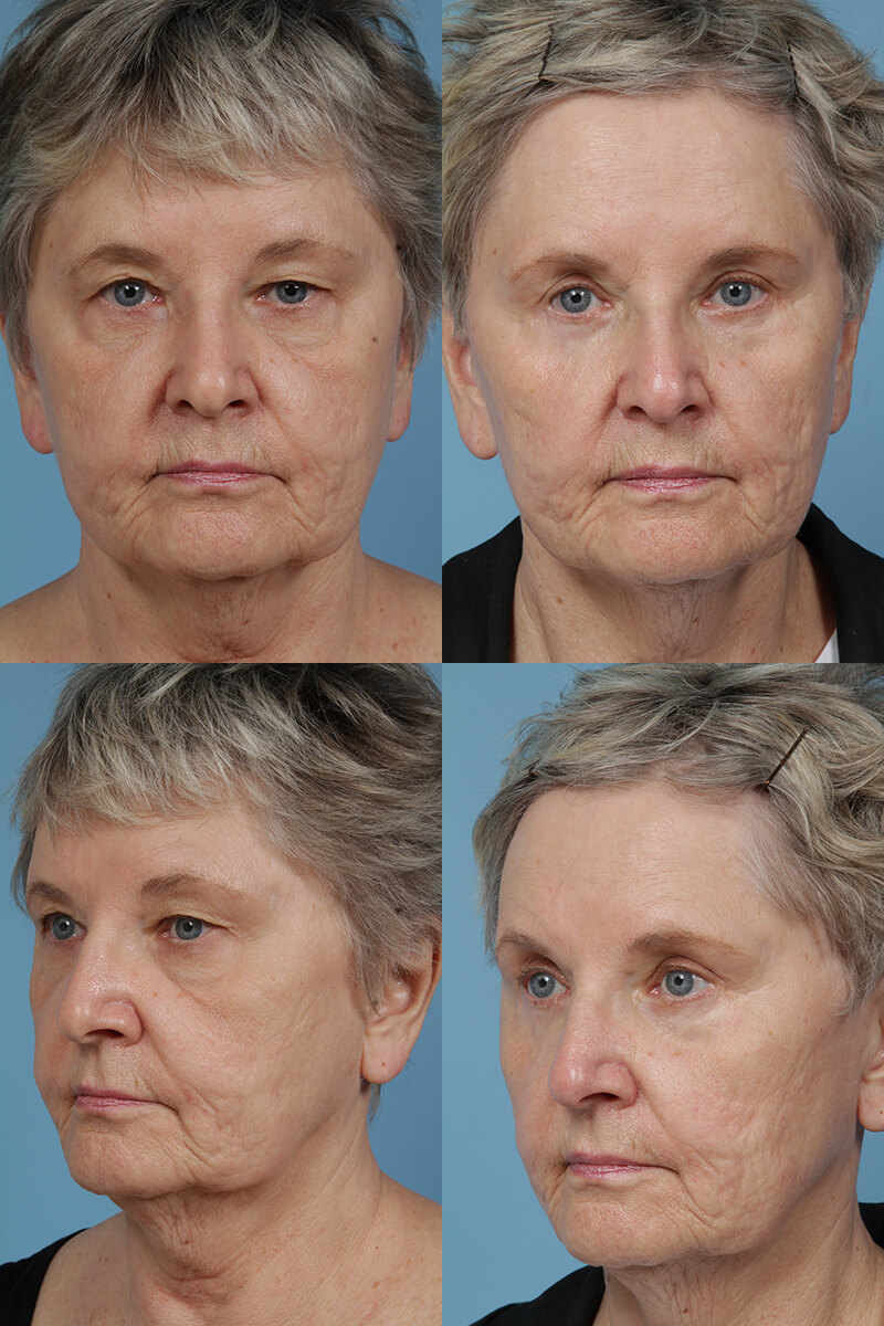 Lower Eyelid Gallery - Dr. Alghoul
